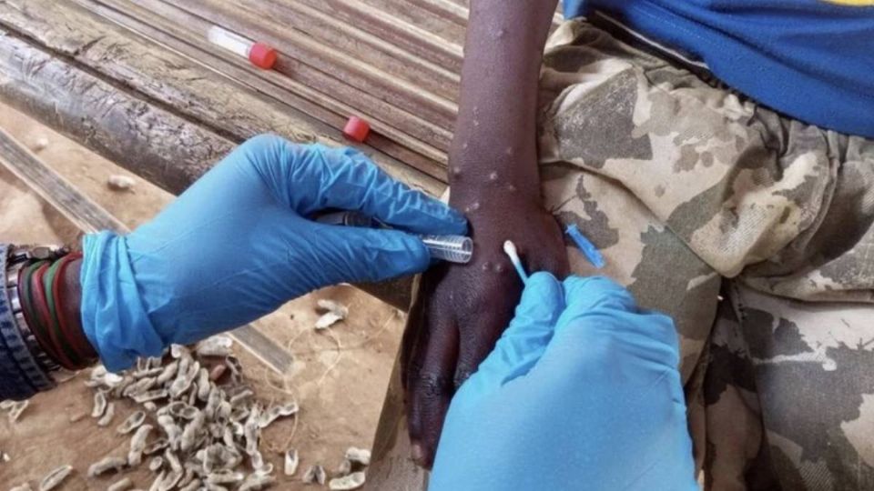 Mpox o viruela de mono: ¿Cómo se contagia este peligroso virus ...